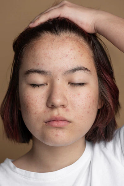 4 Good Reasons Not To Pop Your Pimples No Matter How Tempted You Are ...